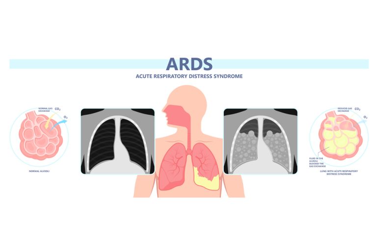 Acute Respiratory Distress Syndrome | MARI REF
